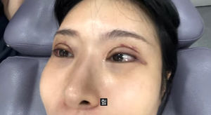 '결별' 이세영, 쌍수 재수술.."살 3kg 빠져, 안면윤곽 수술한듯"('영평티비') - OSEN