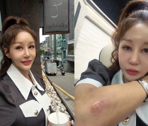 김혜연, 48kg이라더니 계단서 휘청..심한 부상에 걱정 쏟아져 “온몸이 아파” - OSEN